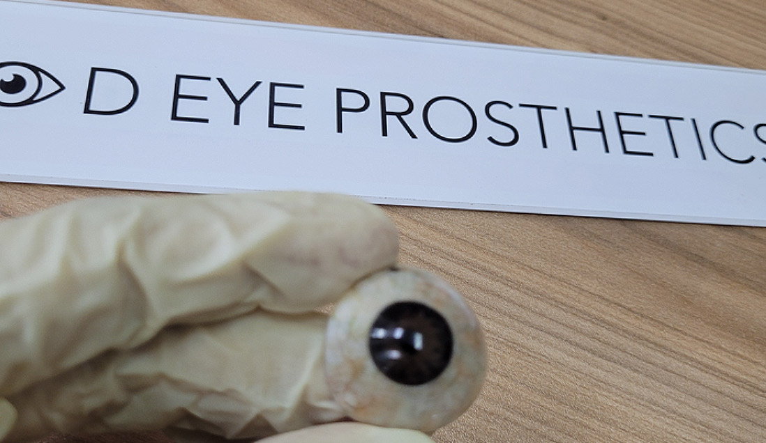 WHAT IS A PROSTHETIC EYE – D EYE PROSTHETICS Prosthetic eye Artificial Eyes and Ocularists Kuala ...